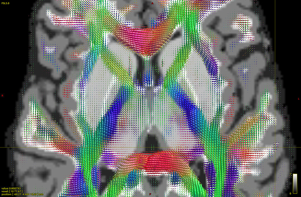 Dwi2response dhollander questions - MRtrix3 Community