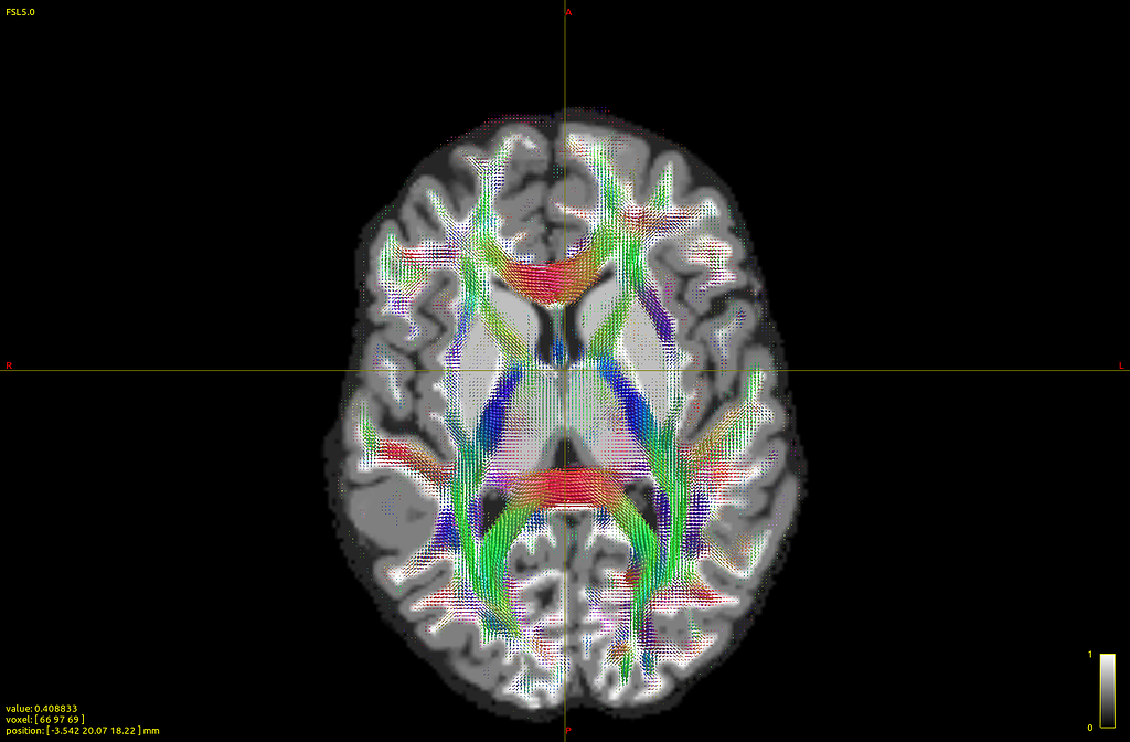 Dwi2response dhollander questions - MRtrix3 Community
