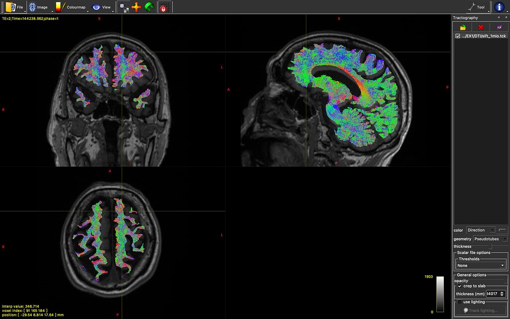 Registration Of Dti To T1 In The Tractograph Analysis Mrtrix3 Community