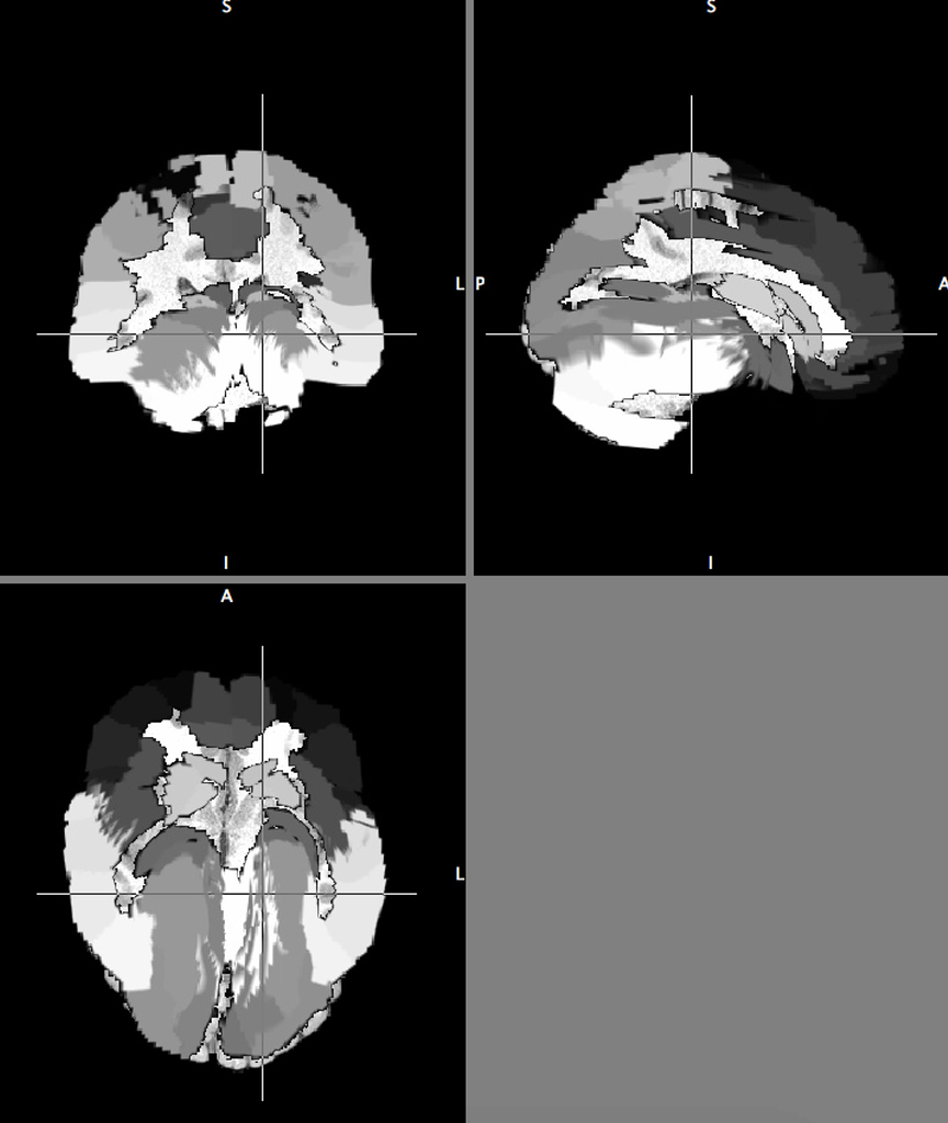 Registration of AAL atlas to subjects' T1 - connectomics - MRtrix3 ...