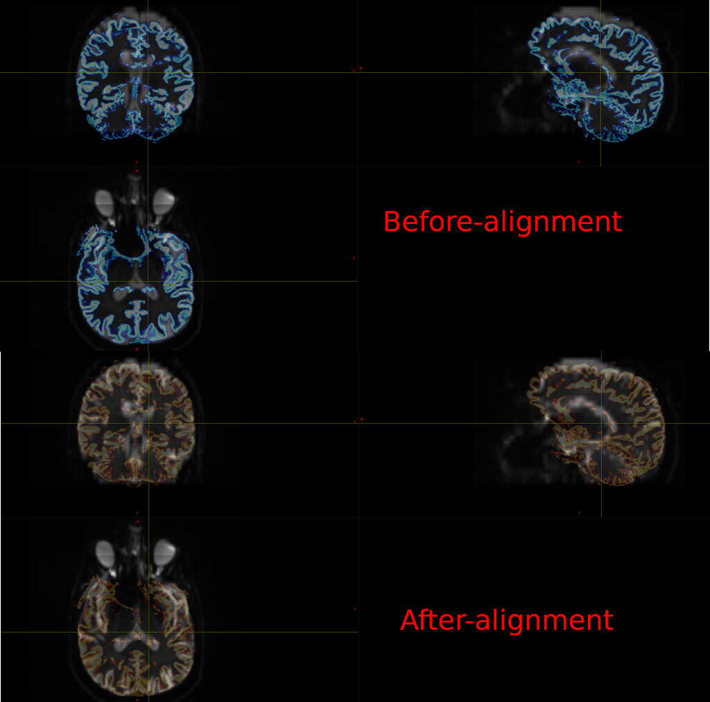 T1 and DWI are already aligned - should I skip registration and transform steps in MRtrix ...
