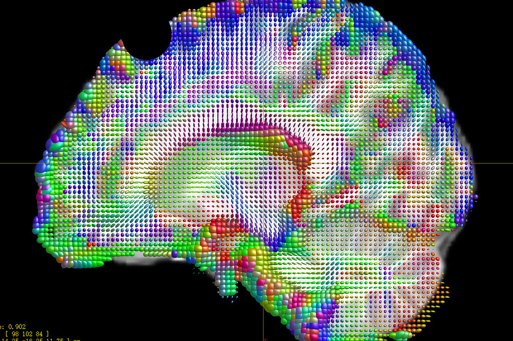 The visualization results of diffusion tensor imaging (DTI) fiber tracts in brain imaging ...
