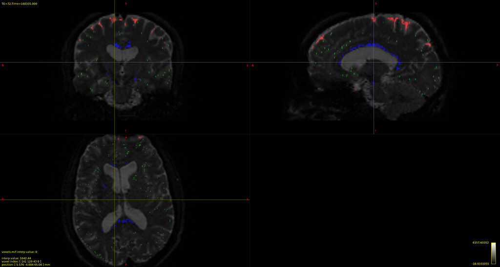 CSF voxel selection in dwi2response dhollander skips ventricles, expected? - tractography ...
