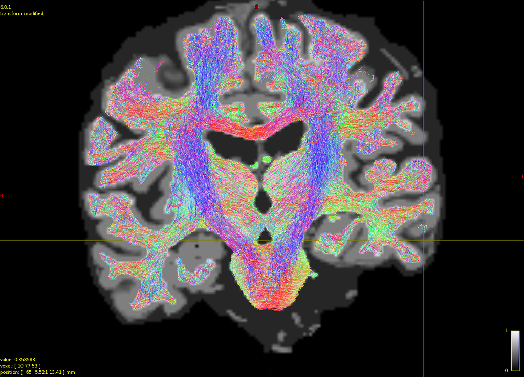 Whole brain tractogram - tractography - MRtrix3 Community