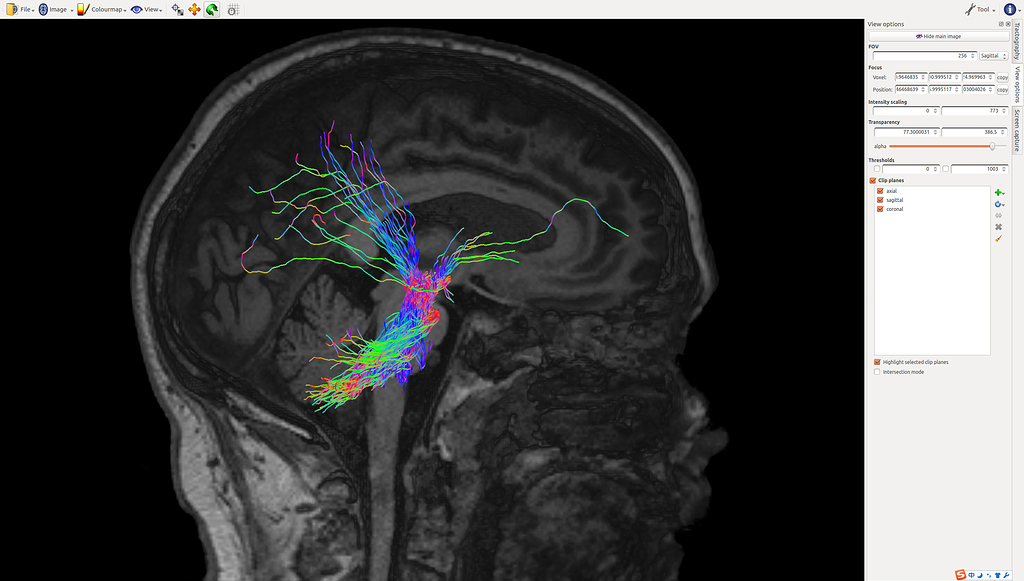 ACT usage and fiber tracts comparison - MRtrix3 Community