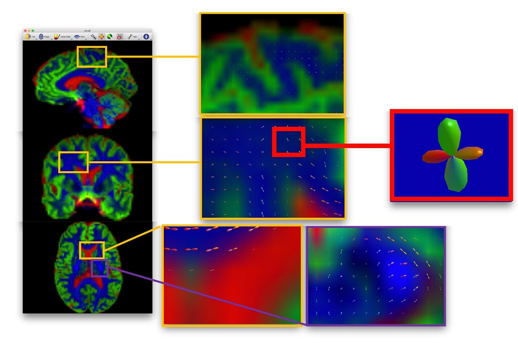 What the result of two shells (one 0, one 1500) using msmt_csd should look like? - tractography ...
