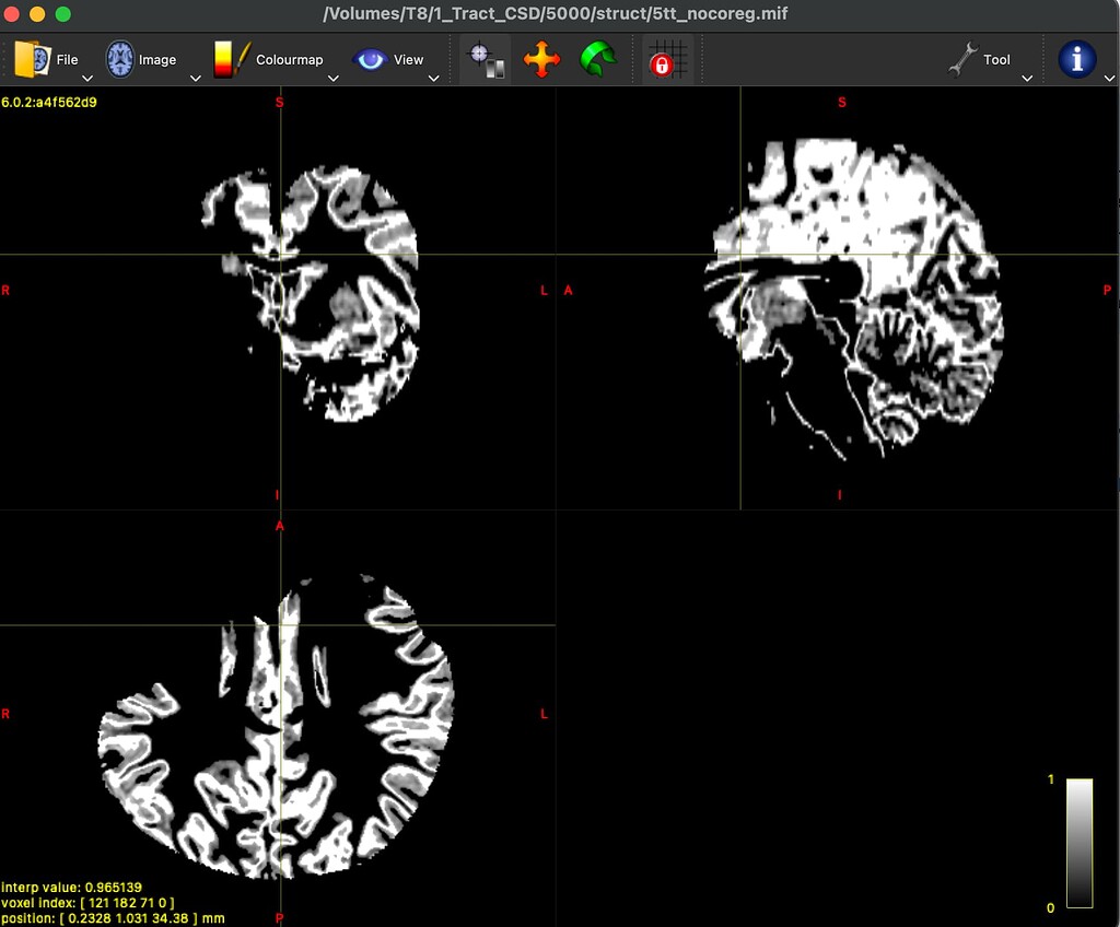 5tt_nocoreg.mif missing frontal cortex - tractography - MRtrix3 Community