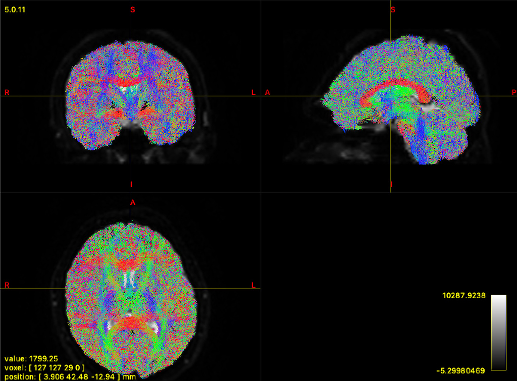 Single shell tractography yields streamlines in GM - MRtrix3 Community