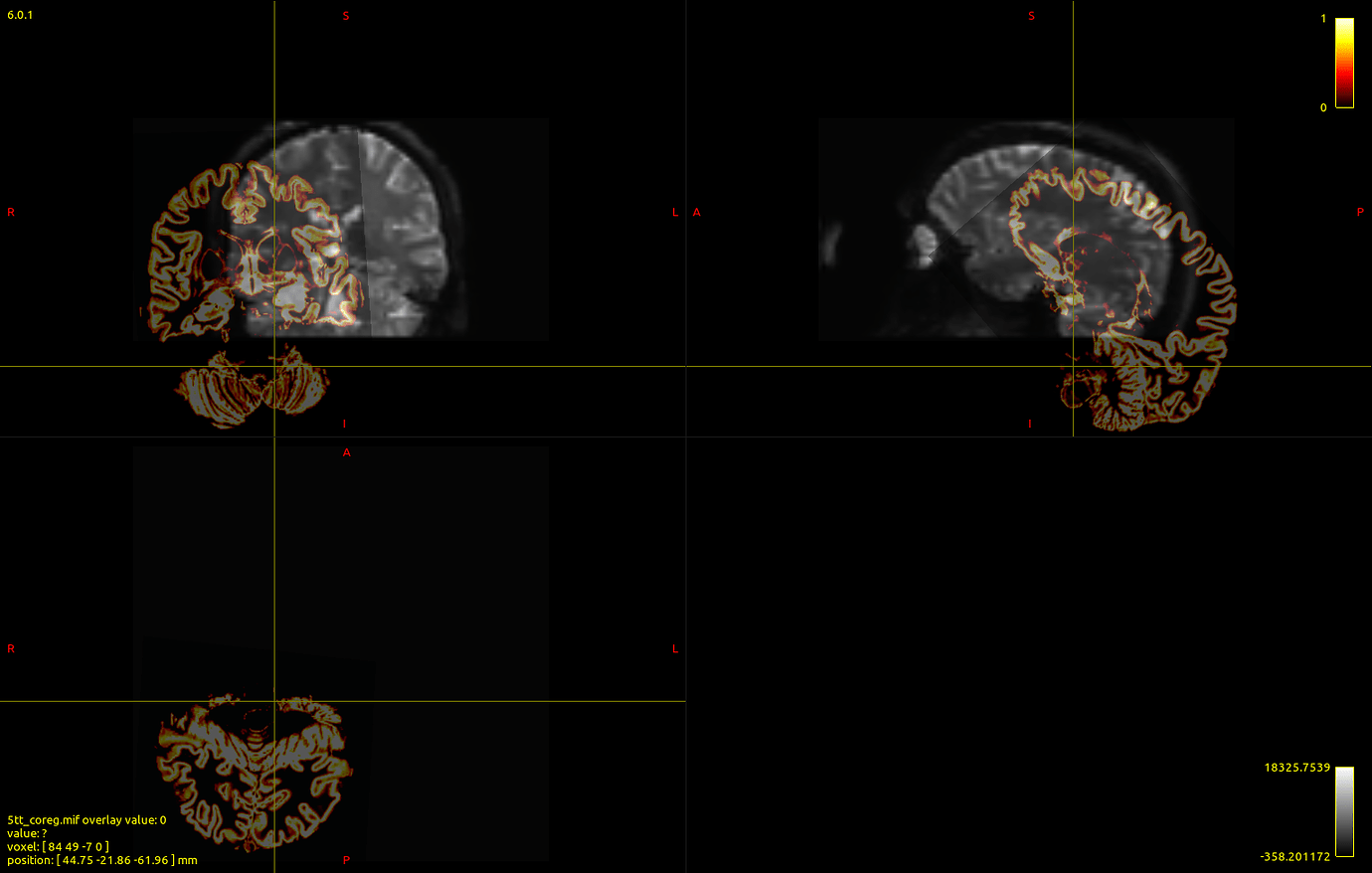 T1w to DWI alignment errors in 5tt ACT - preprocessing - MRtrix3 Community