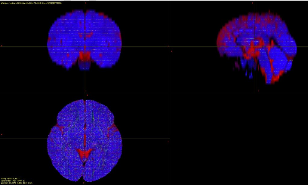 Single-Shell (+B0) 3-Tissue CSD - MRtrix3 Community