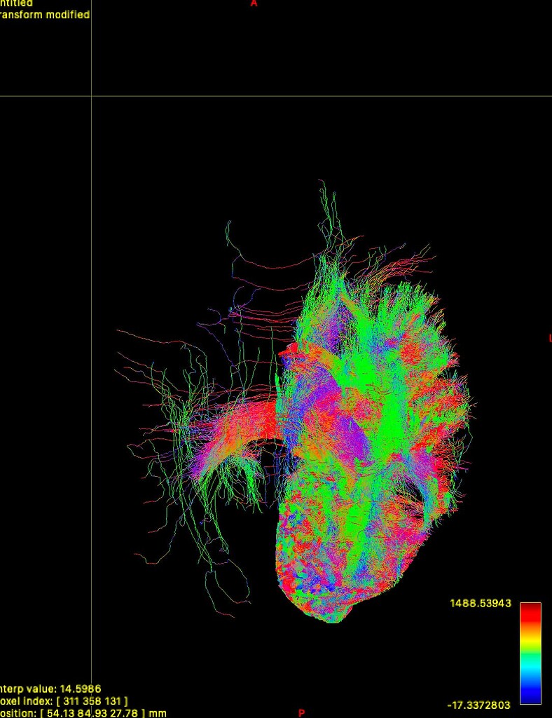 Tckgen -maxlength value for interhemispheric connections - tractography ...