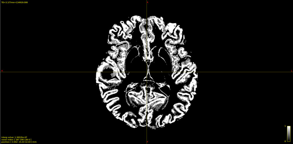 5ttgen segmentation is wrong for pathological tissue - MRtrix3 Community