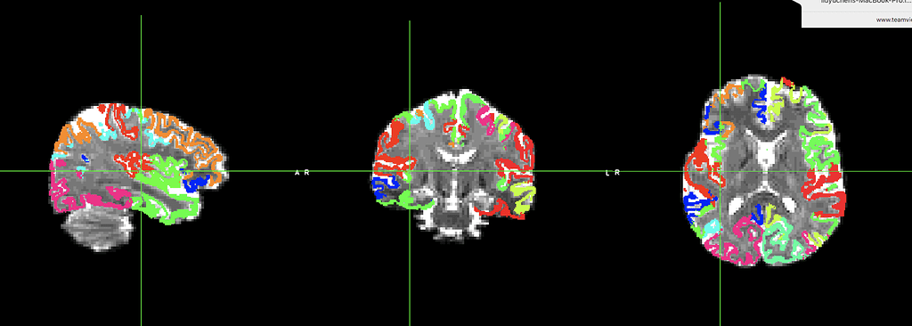 Register atlas to DWI space - MRtrix3 Community