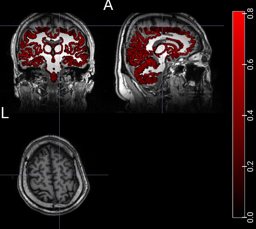 Challenges with Seed Generation using '5ttgen fsl' for Anatomically ...