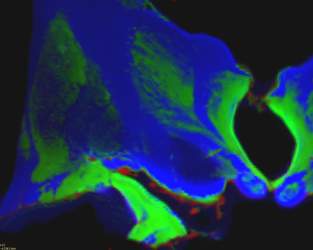 DWI preprocessing dwi2response output differences between subjects - preprocessing - MRtrix3 ...