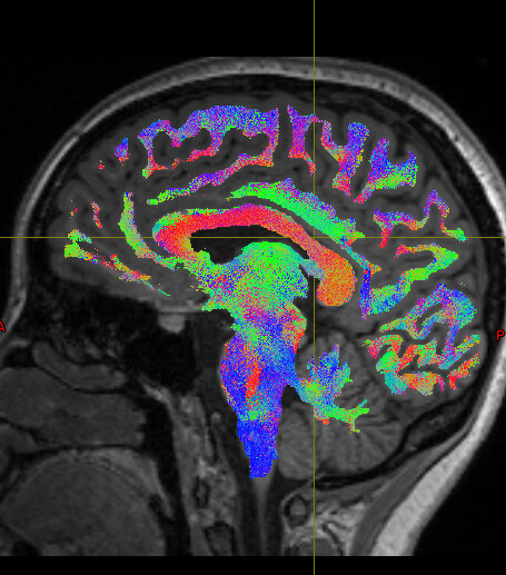Whole-brain tck to MNI - tractography - MRtrix3 Community